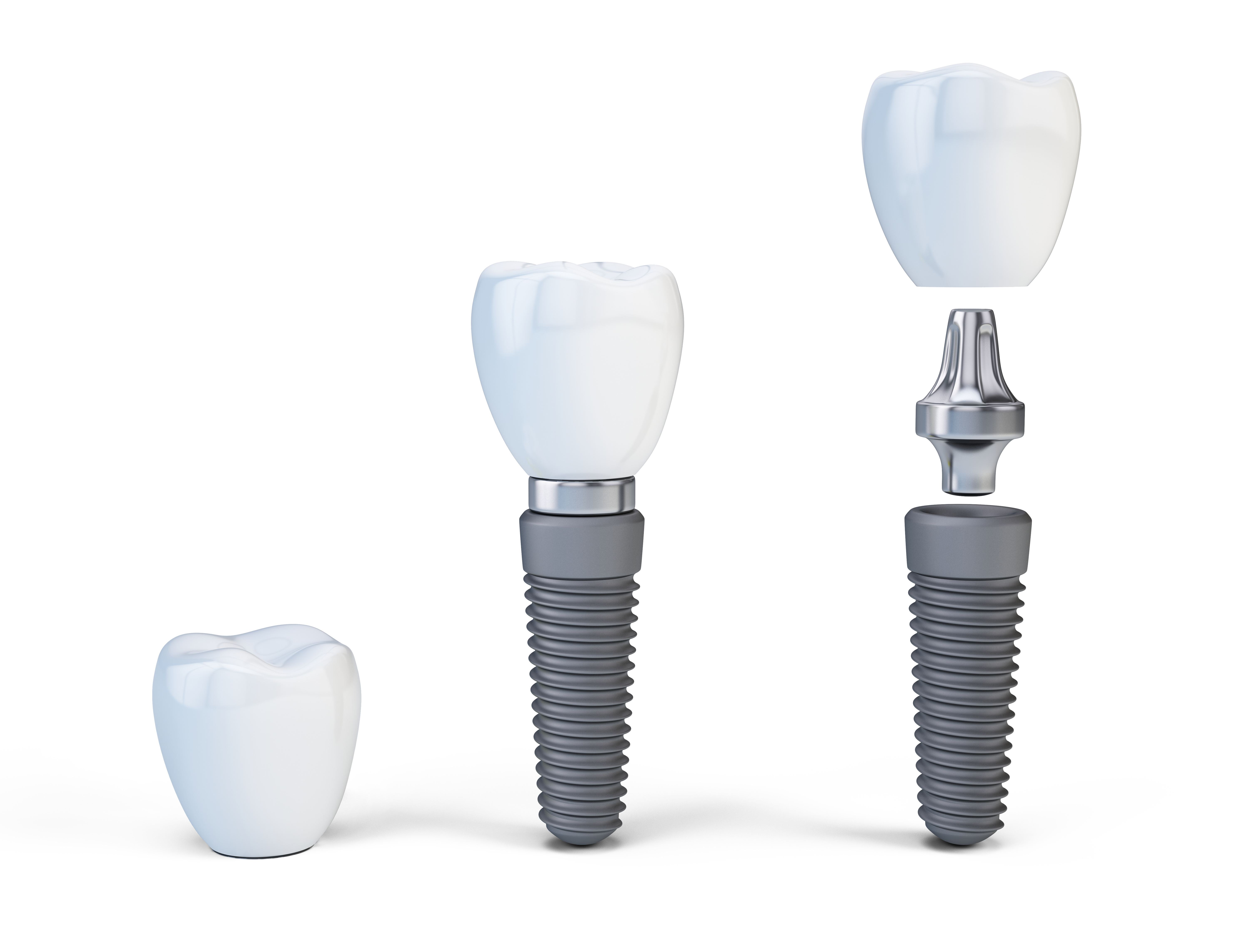 Tooth human implant isolated on white. 3d render - Family Dental ...